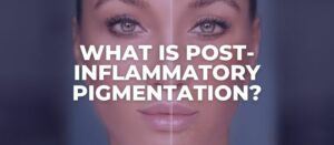 What Is Post-Inflammatory Pigmentation (PIH) In Skincare?