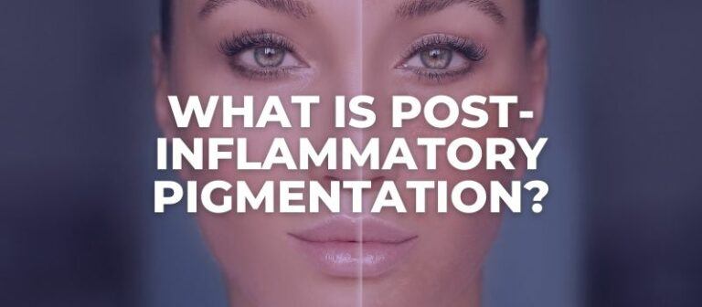What Is Post-Inflammatory Pigmentation (PIH) In Skincare?