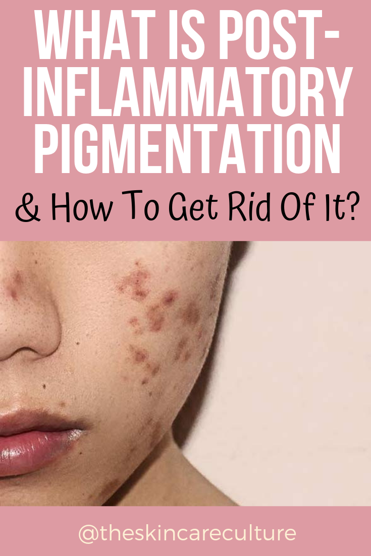 What Is Post-Inflammatory Pigmentation (& How To Get Rid Of It)?