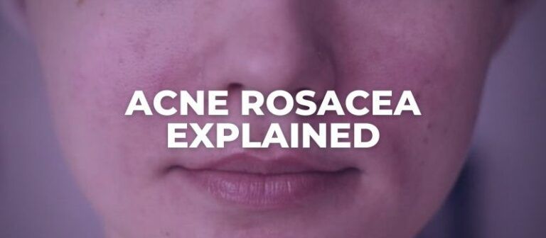 What Is Acne Rosacea (& How To Treat It)?
