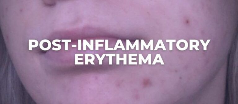 What Is Post-Inflammatory Erythema (& How To Get Rid Of It)?