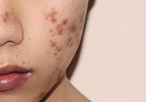 What Is Post-Inflammatory Pigmentation (PIH) In Skincare?