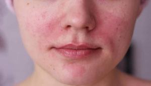 What Is Acne Rosacea (& How To Treat It)?