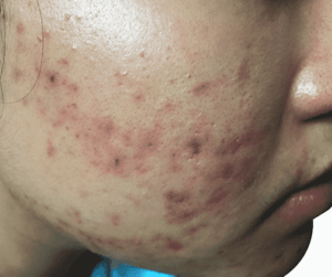 8 Different Types Of Acne (With Pictures)
