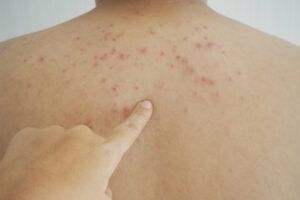 8 Different Types Of Acne (With Pictures)