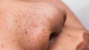 8 Different Types Of Acne (With Pictures)