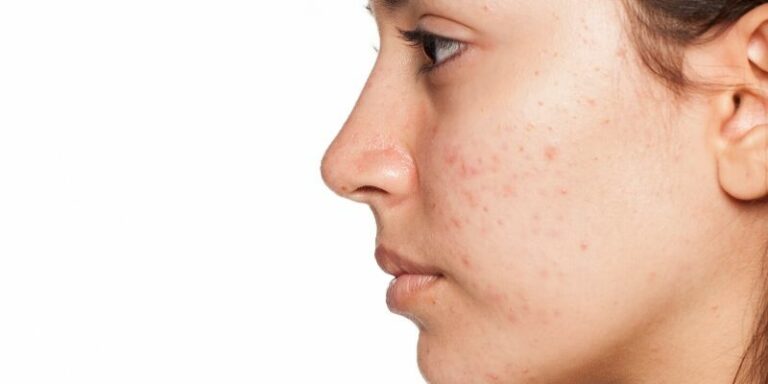 Can You Use Toothpaste on Acne? (An Esthetician Explains)