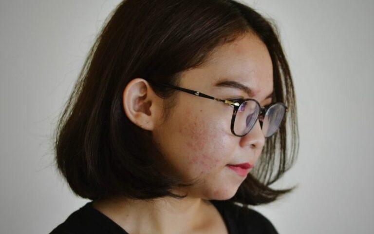 How To Get Rid Of Cheek Acne (An Esthetician Explains)