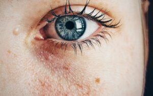 5 Best Products To Get Rid of Closed Comedones