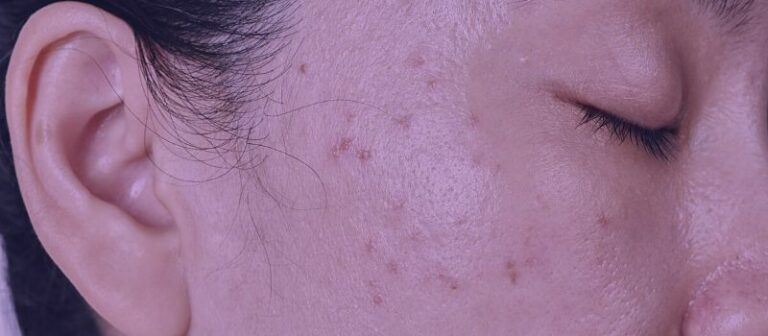 Glycolic Acid vs. Salicylic Acid for Closed Comedones