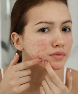 How To Treat Acne Caused By Birth Control