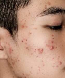 How to Soothe Acne Itching (Expert Tips & Solutions)