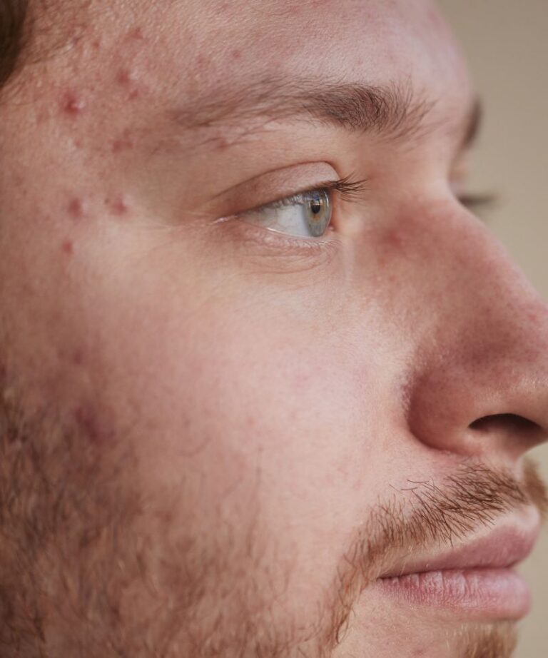 How to Get Over a Retinoid Purge?