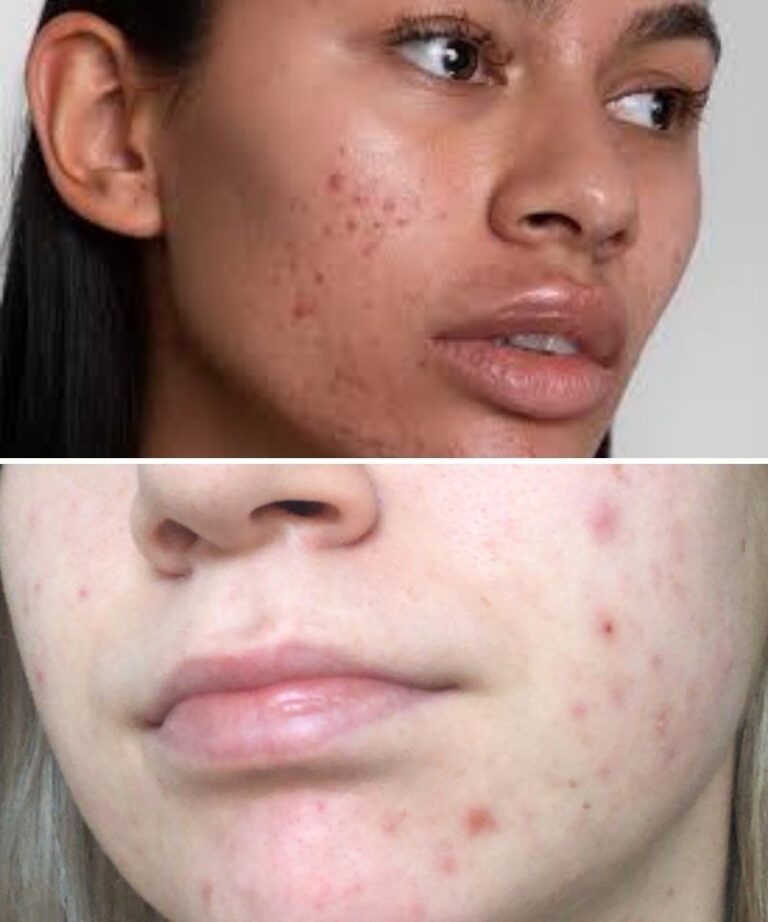 What Is Post-Inflammatory Erythema (& How To Get Rid Of It)?