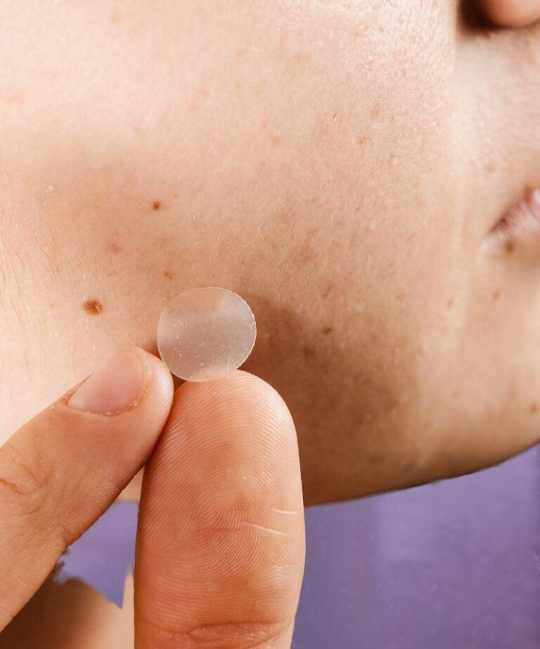 The Differences Between Acne Spot Treatment and Acne Serum